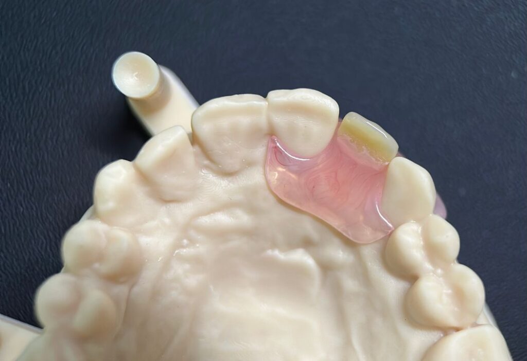 Flexible Denture - Istar leading China dental lab outsourcing