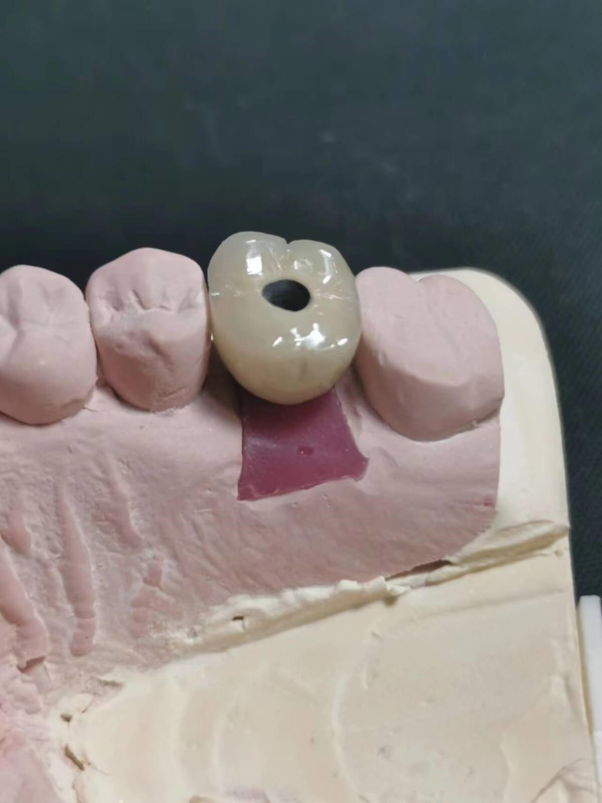 Screw-retained Implant - Istar leading China dental lab outsourcing