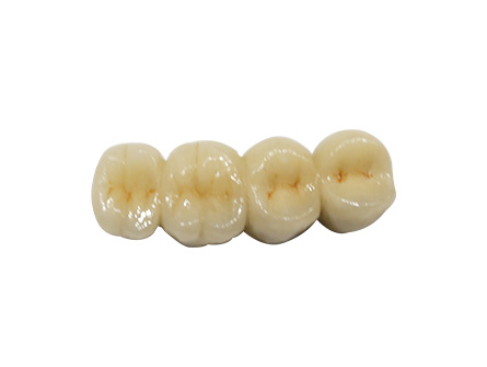 PFM Posterior Bridges | Dental Lab Services | Istar