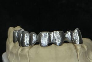 PFM Posterior Bridges | Dental Lab Services | Istar