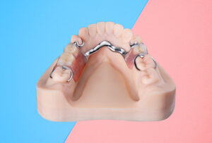 Precision Metal Dentures | Istar Dental Lab