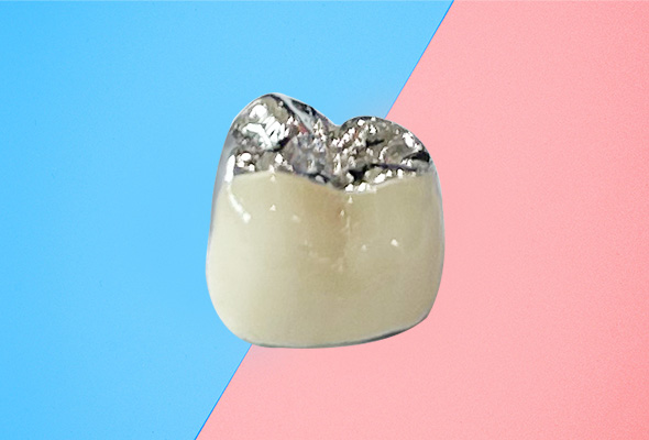 PFM Crown Metal Occlusal - Personal Istar Dental Laboratory