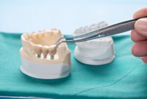 PFM Posterior Bridges | Dental Lab Services | Istar