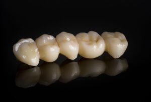 PFM Posterior Bridges | Dental Lab Services | Istar