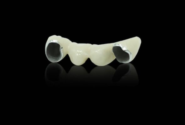High-Quality PFM Bridges - Durable, Aesthetic Restorations