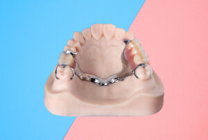 Precision Metal Dentures | Istar Dental Lab