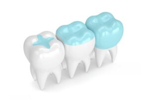 Inlays y Onlays Dentales de Precisión | Istar Dental Lab