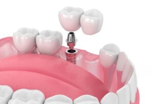 Istar | Premium PFM Cantilever Bridge Solutions