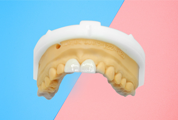 Premium Emax Veneers | Professional Dental Lab | Istar