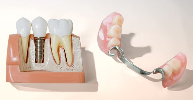 Flexi Denture Single Tooth by Istar - FDA Certified