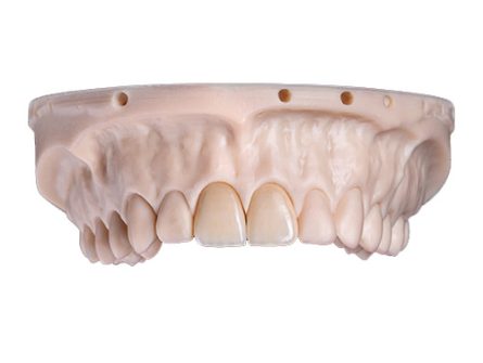 Dental Inlays and Onlays